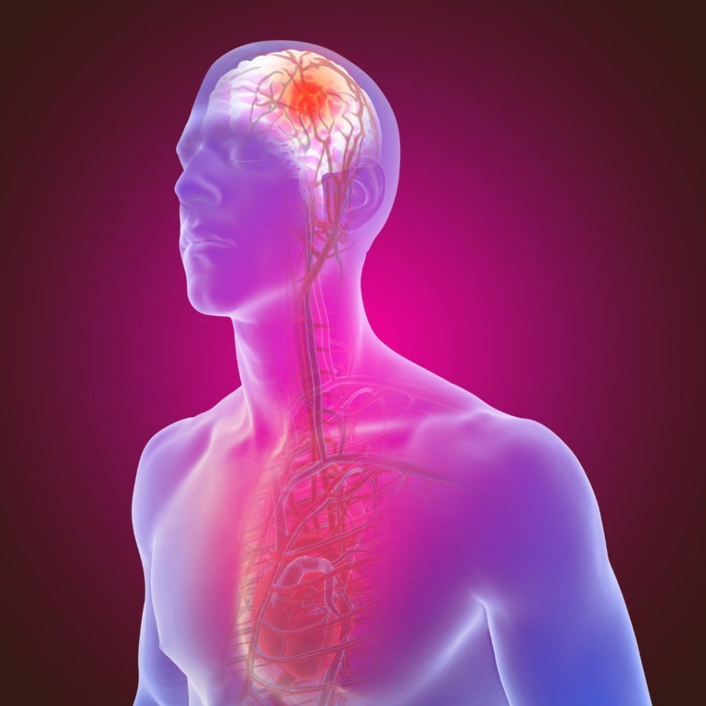 Cerebro- and Endovascular Neurosurgery | NSPC Brain & Spine Surgery