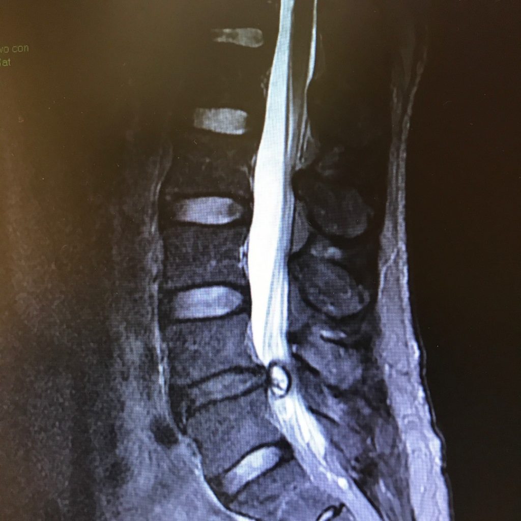 Lumbar Spinous Process Plating | NSPC Brain & Spine Surgery