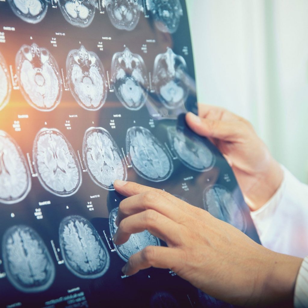 XLIF® Lateral Lumbar Interbody Fusion | NSPC Brain & Spine Surgery