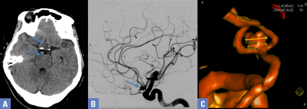 Hunt Hess Grade 1 Subarachnoid Hemorrhage (SAH) | NSPC Brain & Spine ...