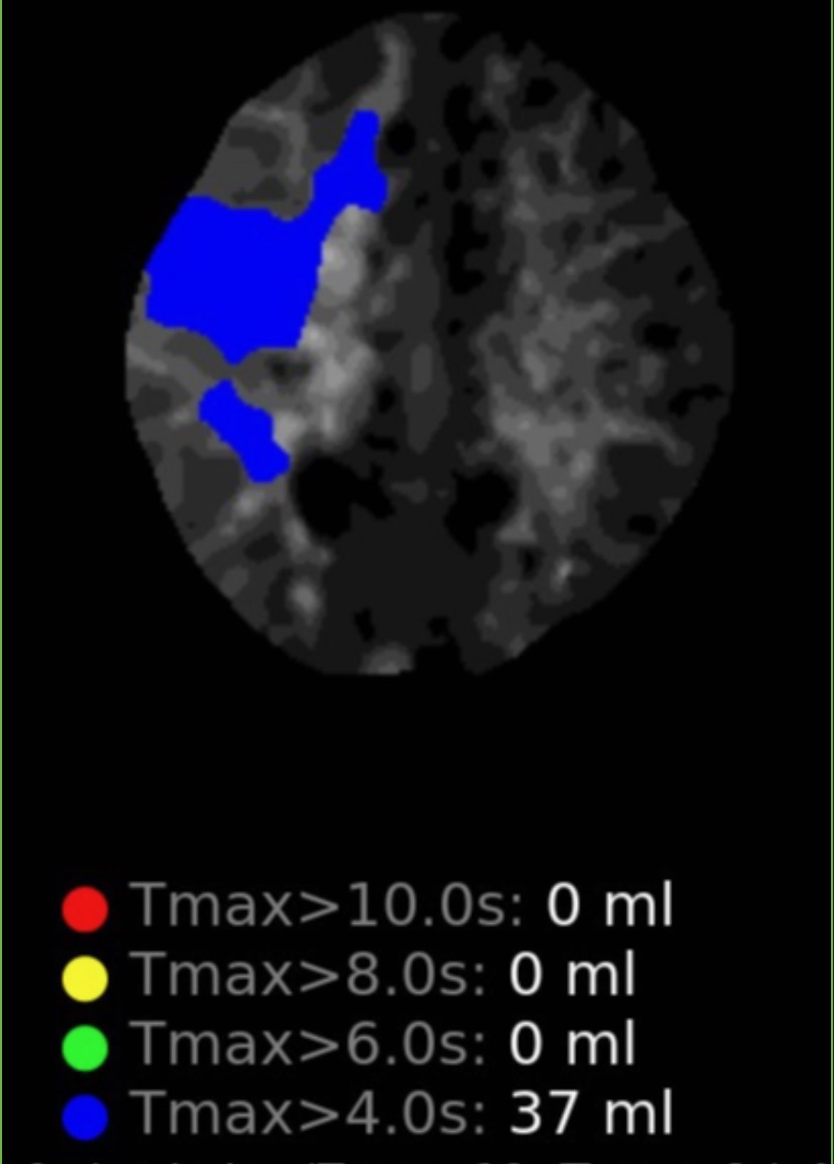 Indirect EDAS Revascularization Treats Moya-Moya Syndrome | NSPC Brain ...