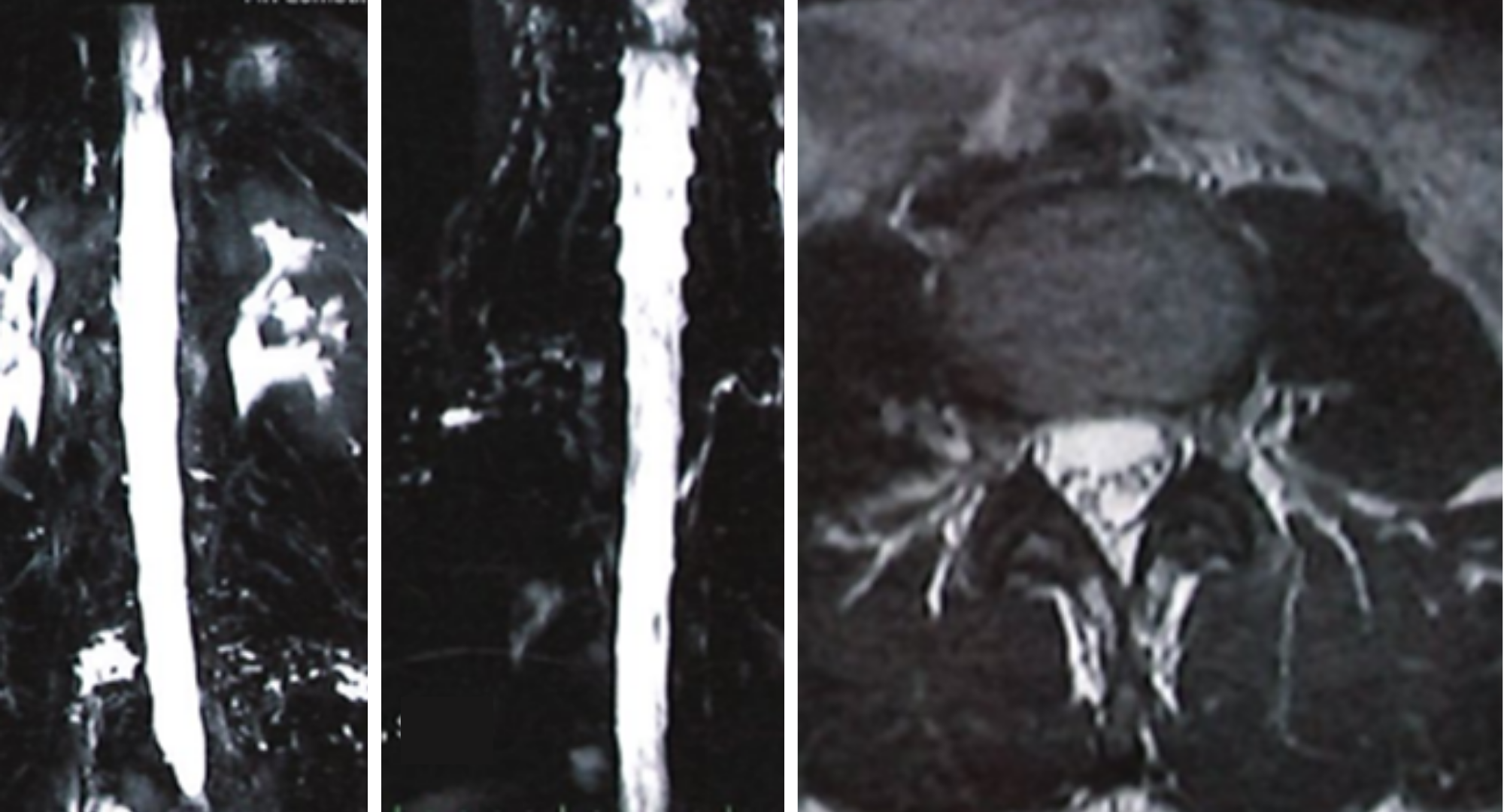 Severe Intractable Postural Headaches in a Young Lady | NSPC Brain ...