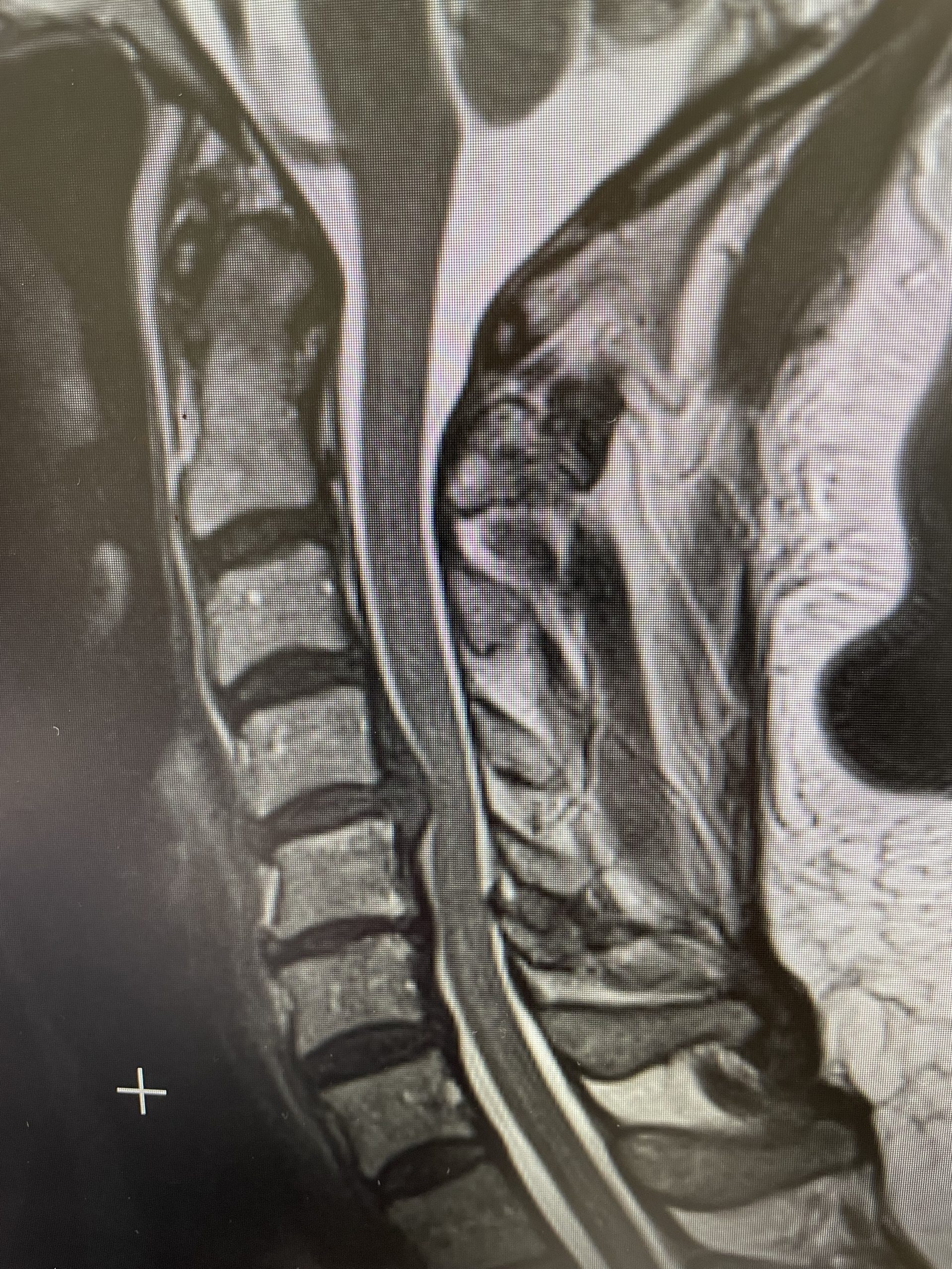 Cervical Spinal Cord Compression With Myelopathy | NSPC Brain & Spine ...