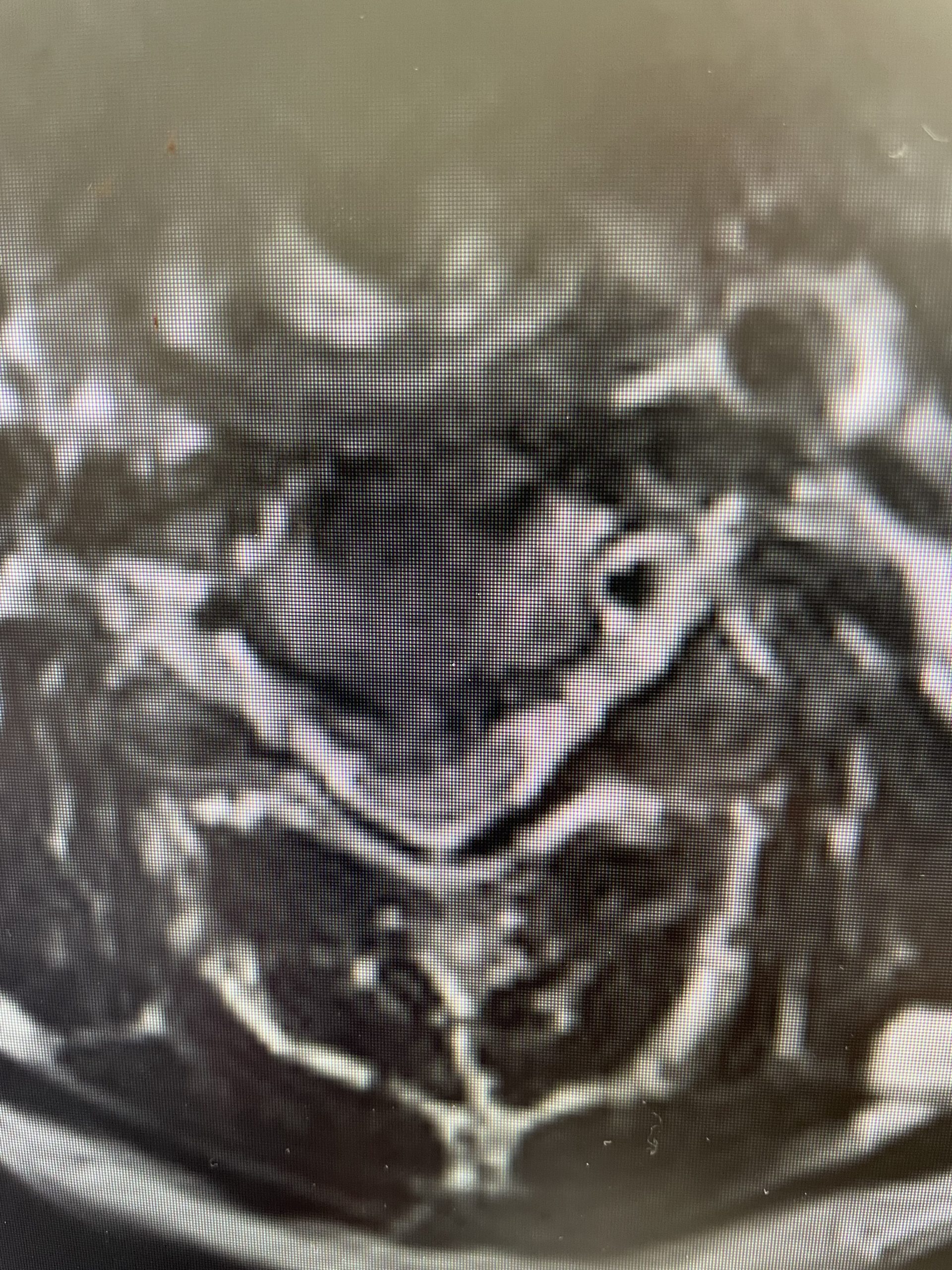 Cervical Spinal Cord Compression With Myelopathy | NSPC Brain & Spine ...