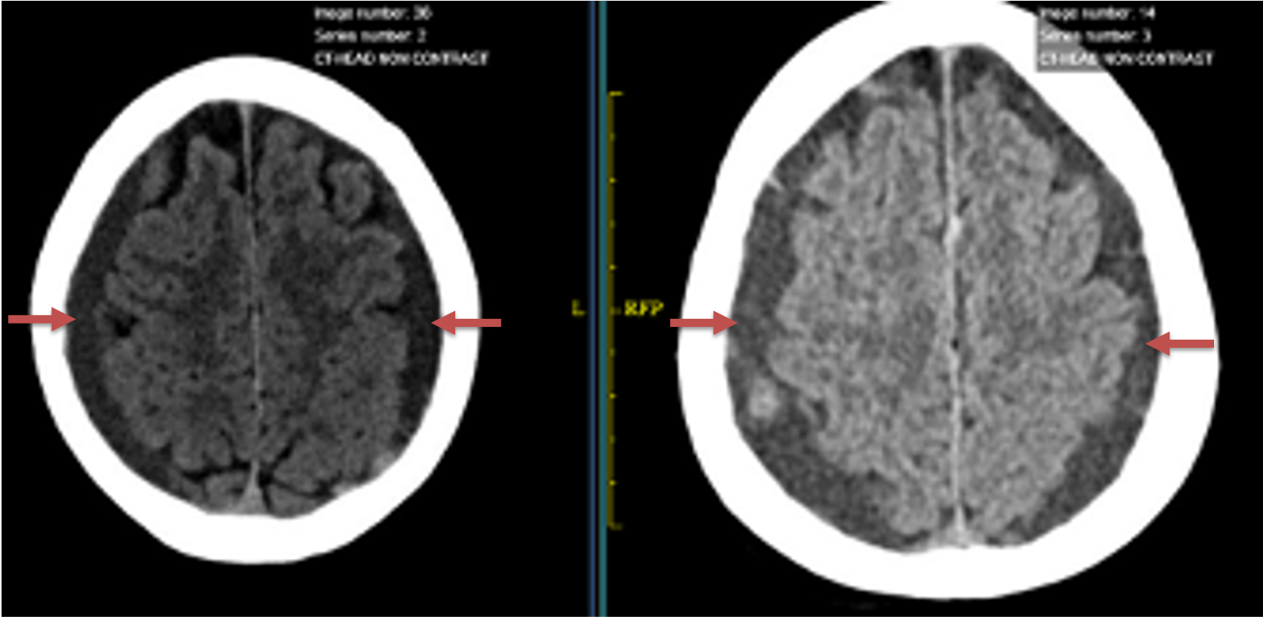 Middle Meningeal Artery Embolization of Bilateral Subacute Subdural ...