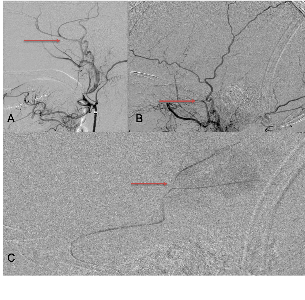 Middle Meningeal Artery Embolization of Bilateral Subacute Subdural Hematomas | NSPC Brain ...