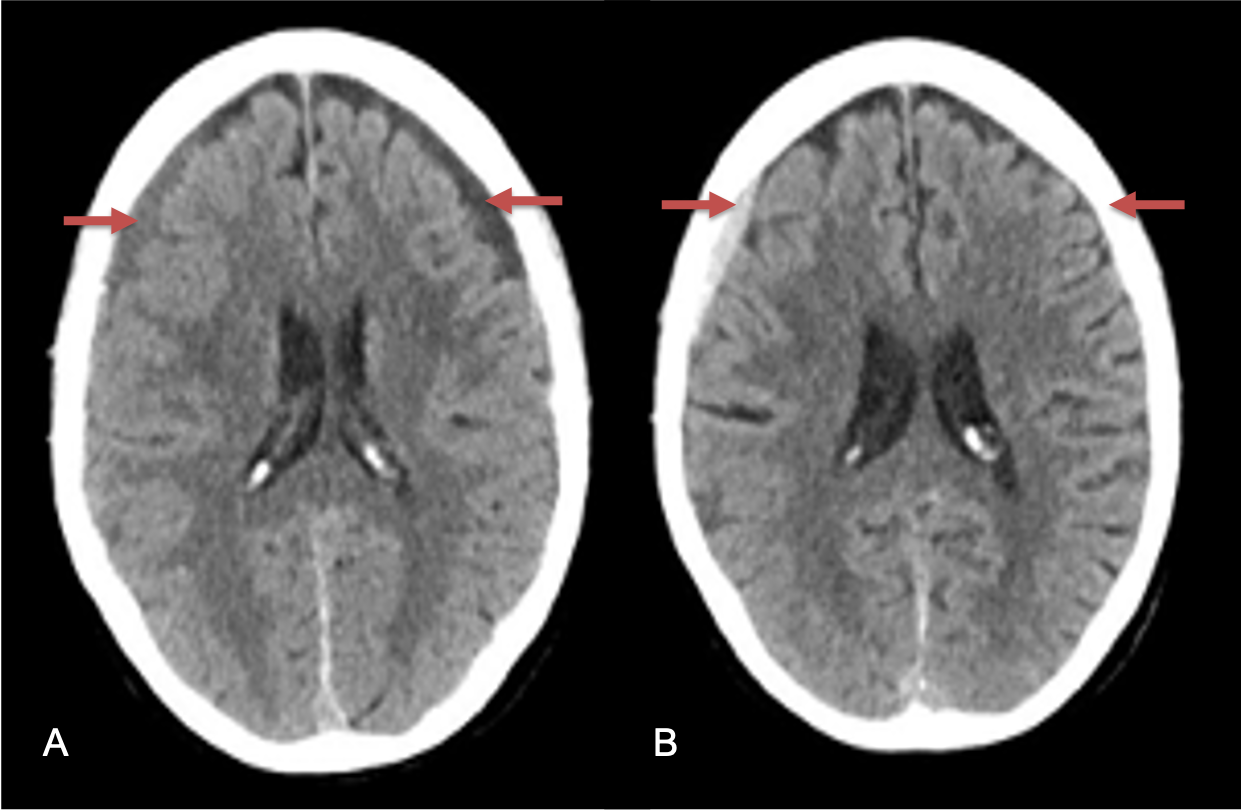 Middle Meningeal Artery Embolization of Bilateral Subacute Subdural ...