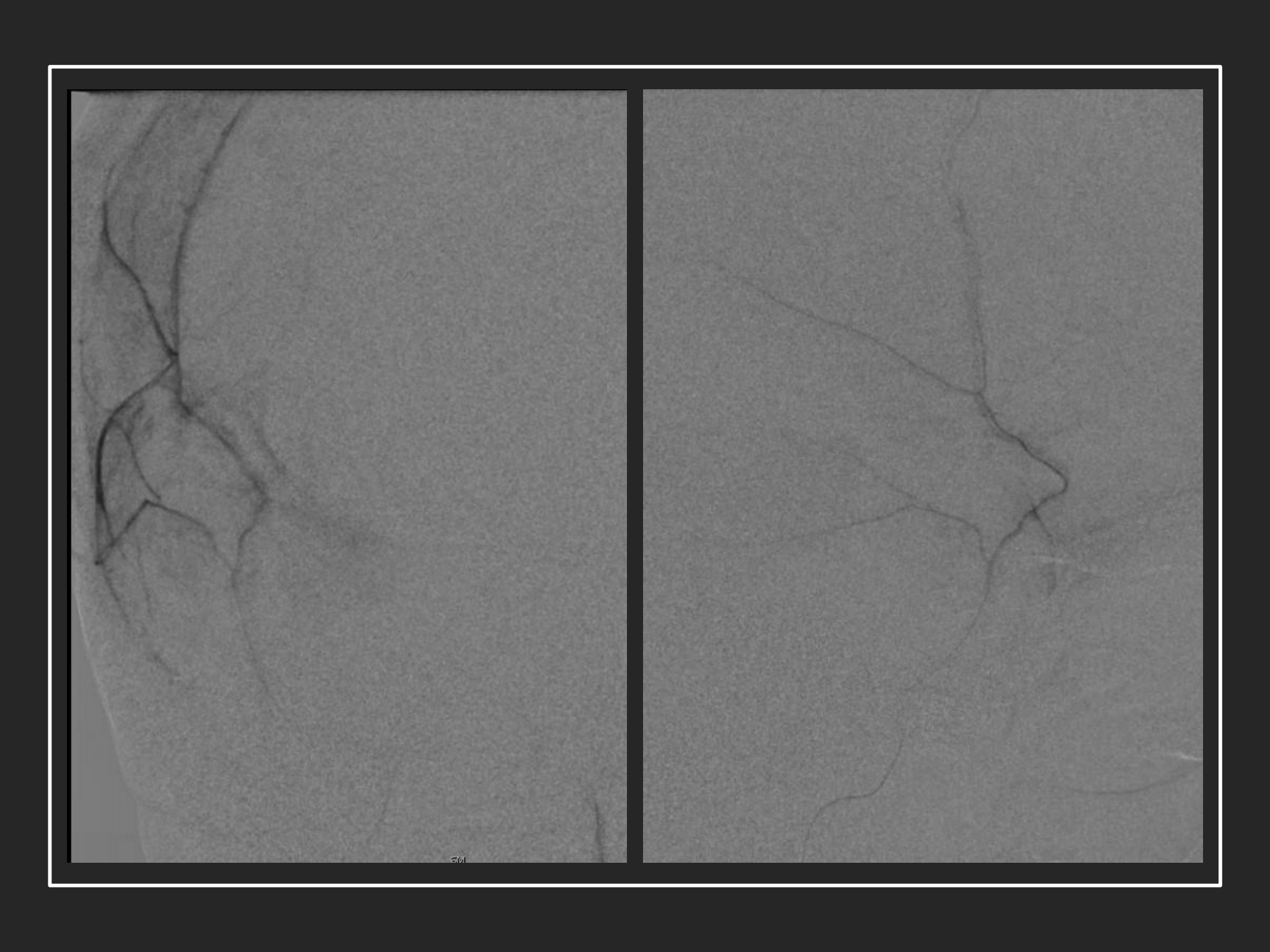 Middle Meningeal Artery Embolization of Bilateral Subacute Subdural ...