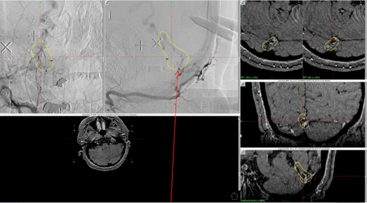 Ruptured Dural AV Fistula/AVM of the Posterior Fossa | NSPC Brain ...