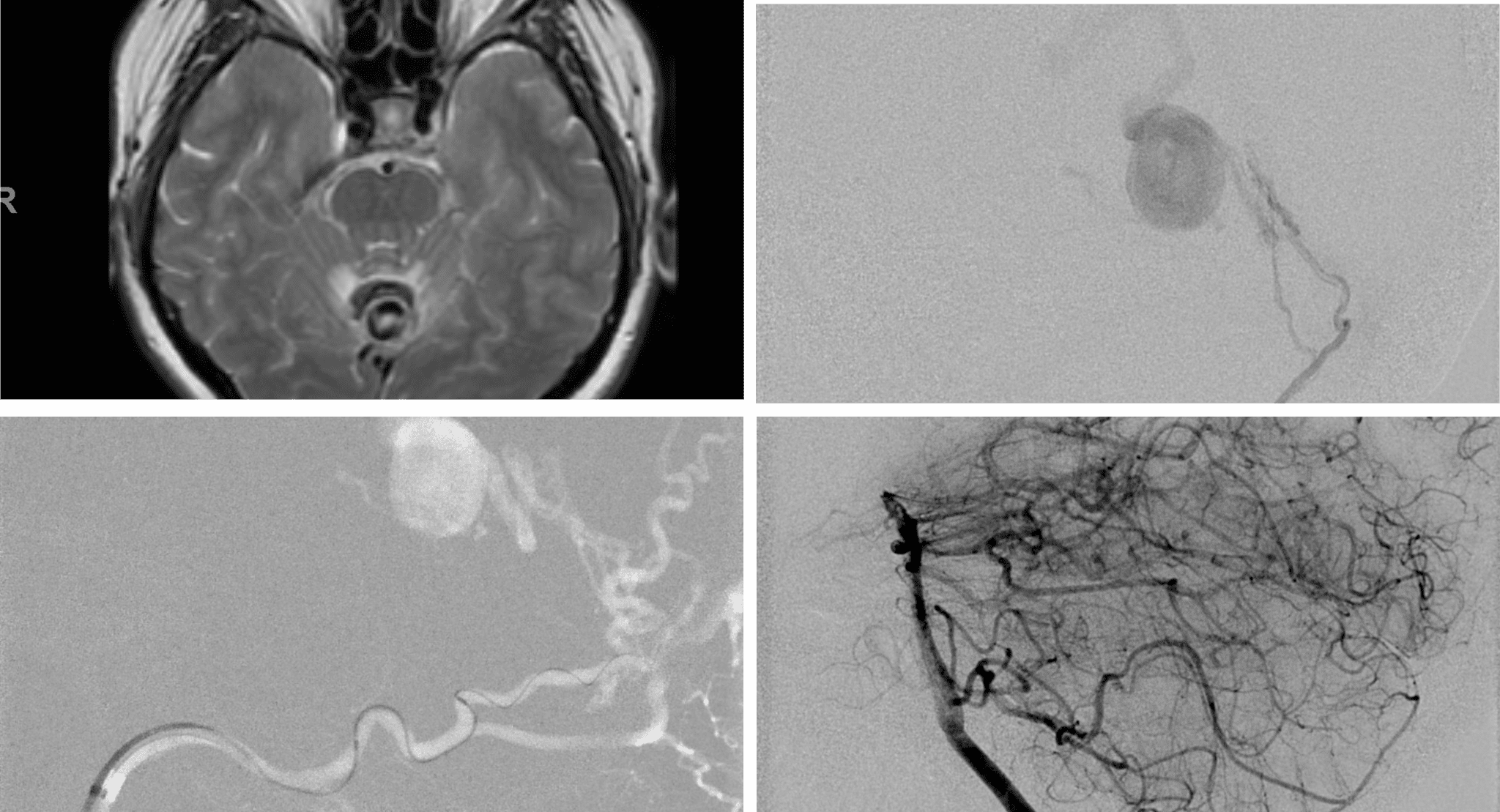 Ruptured Dural AV Fistula/AVM of the Posterior Fossa | NSPC Brain & Spine Surgery