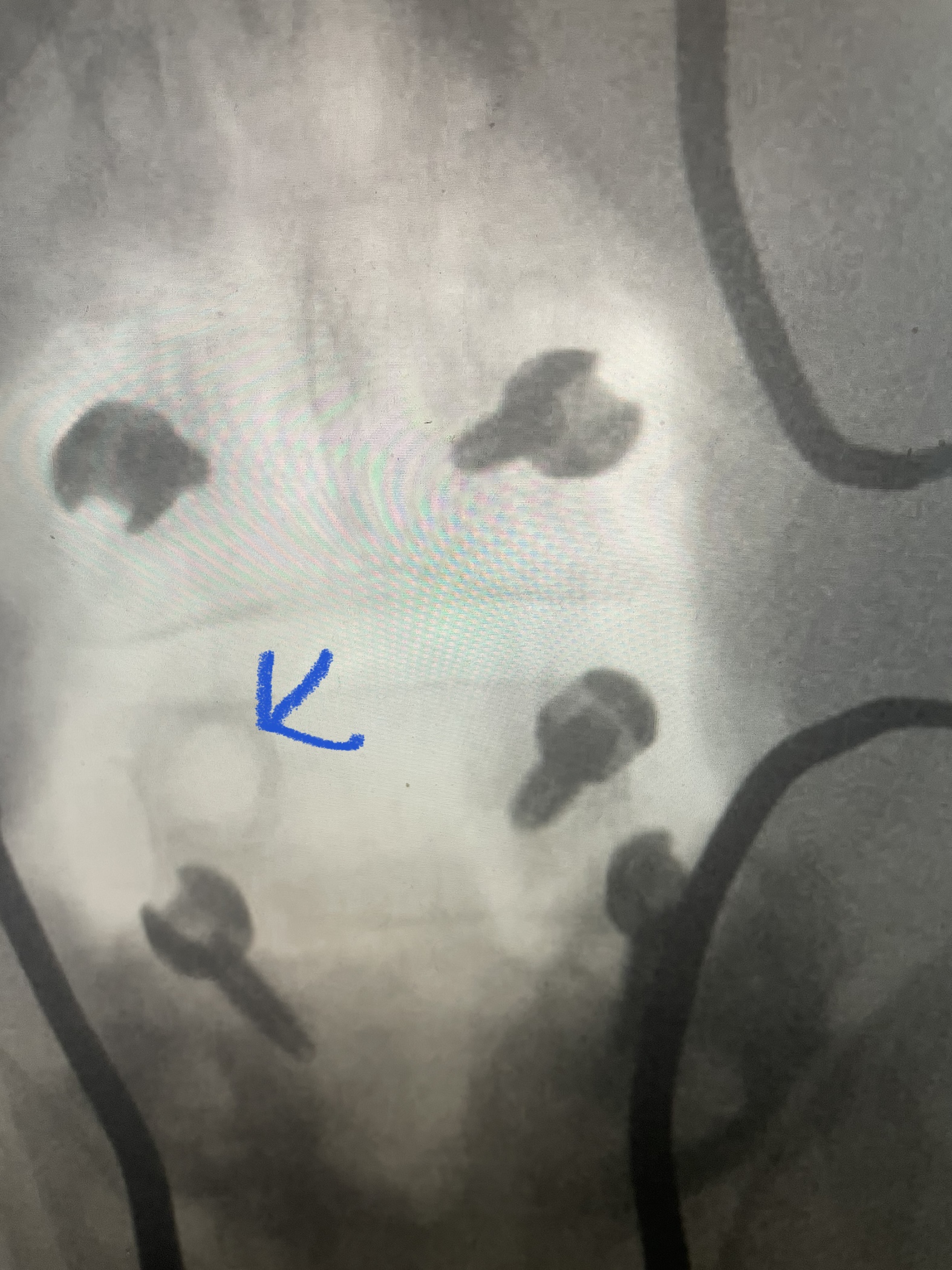 Revision Lumbar Surgery | NSPC Brain & Spine Surgery