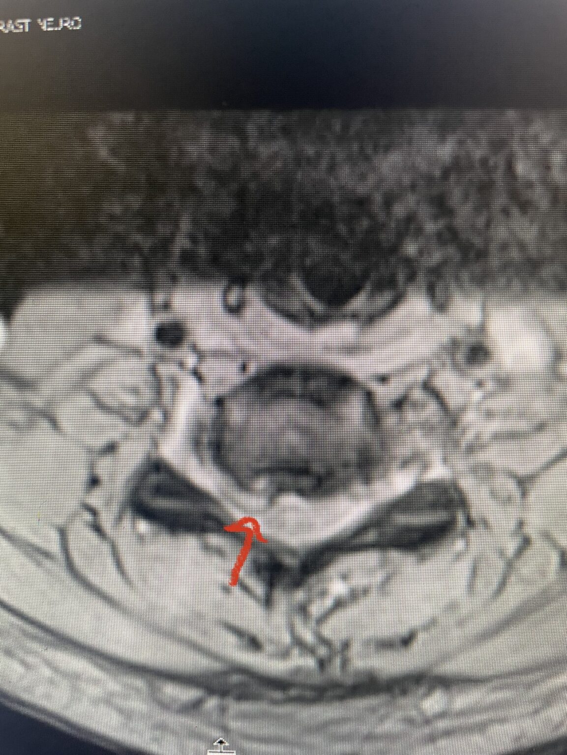Spine Cases Where Surgery Is Clearly Indicated | NSPC Brain & Spine Surgery