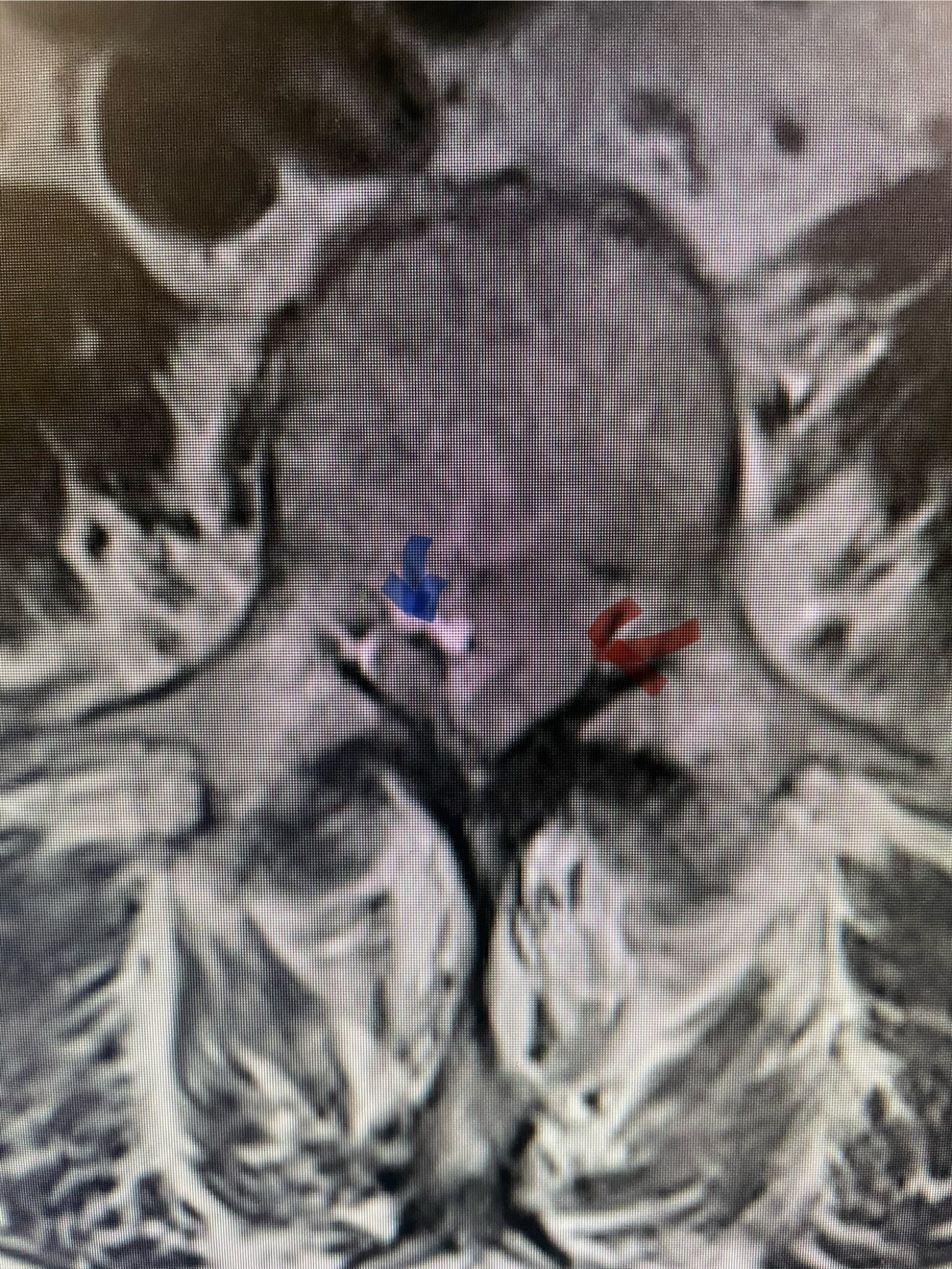 LUMBAR SURGERY CAN BE DONE IN THE MORBIDLY OBESE PATIENT | NSPC Brain ...
