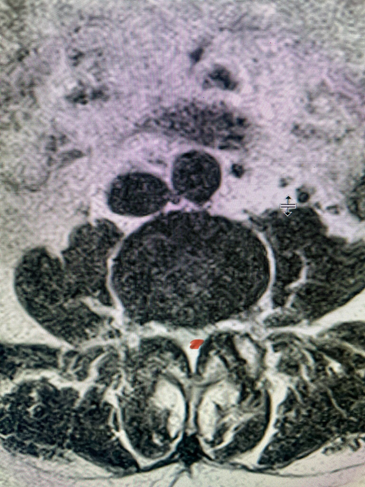 LUMBAR SURGERY CAN BE DONE IN THE MORBIDLY OBESE PATIENT | NSPC Brain ...