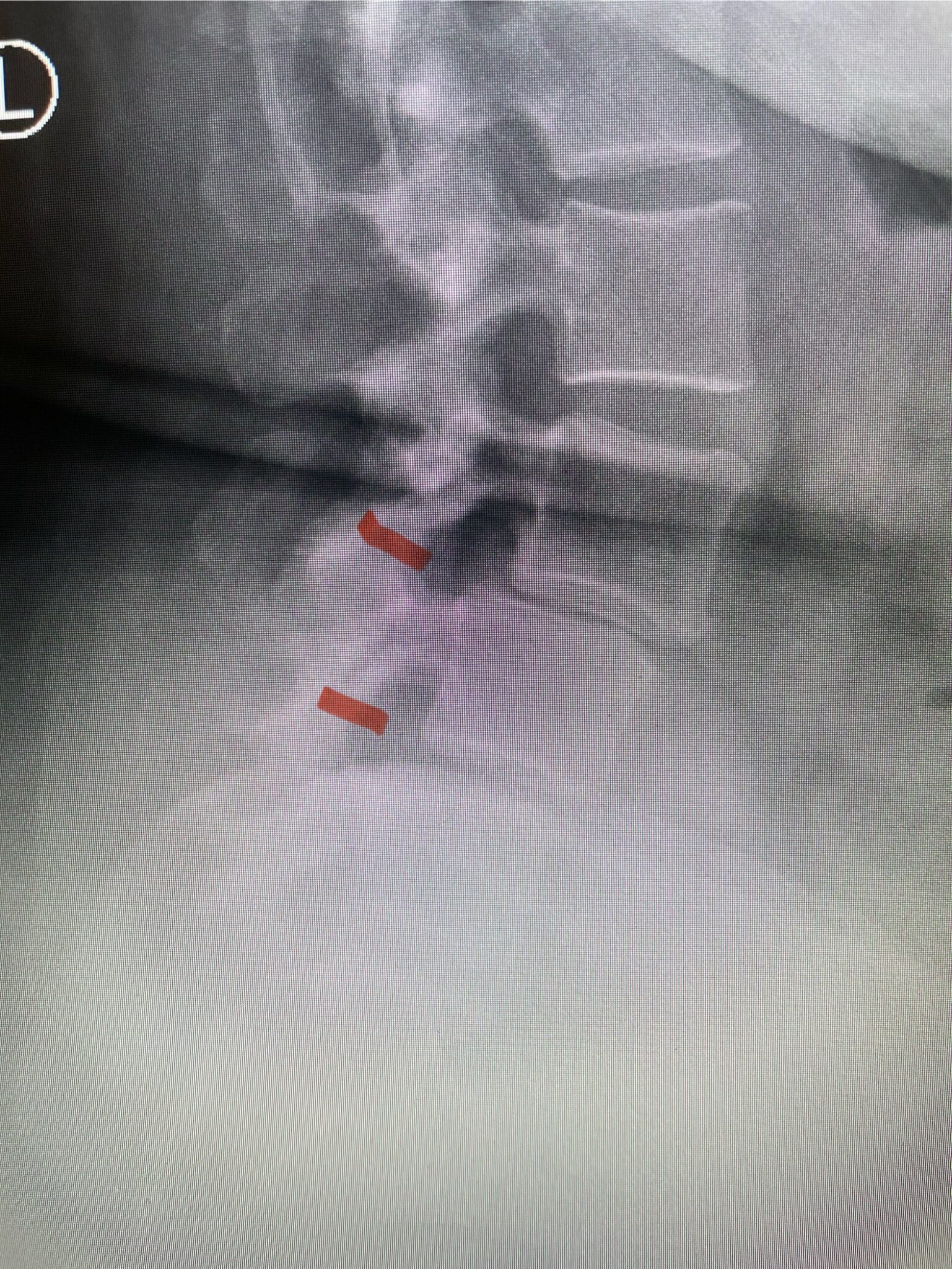 LUMBAR SURGERY CAN BE DONE IN THE MORBIDLY OBESE PATIENT | NSPC Brain ...
